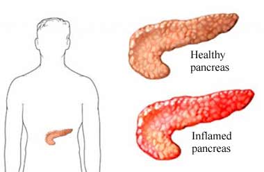 Chronic Pancreatitis - Diabetic Live